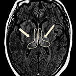 Isolated Pulvinar/Hockey Stick Sign in Nonalcoholic Wernicke’s ...